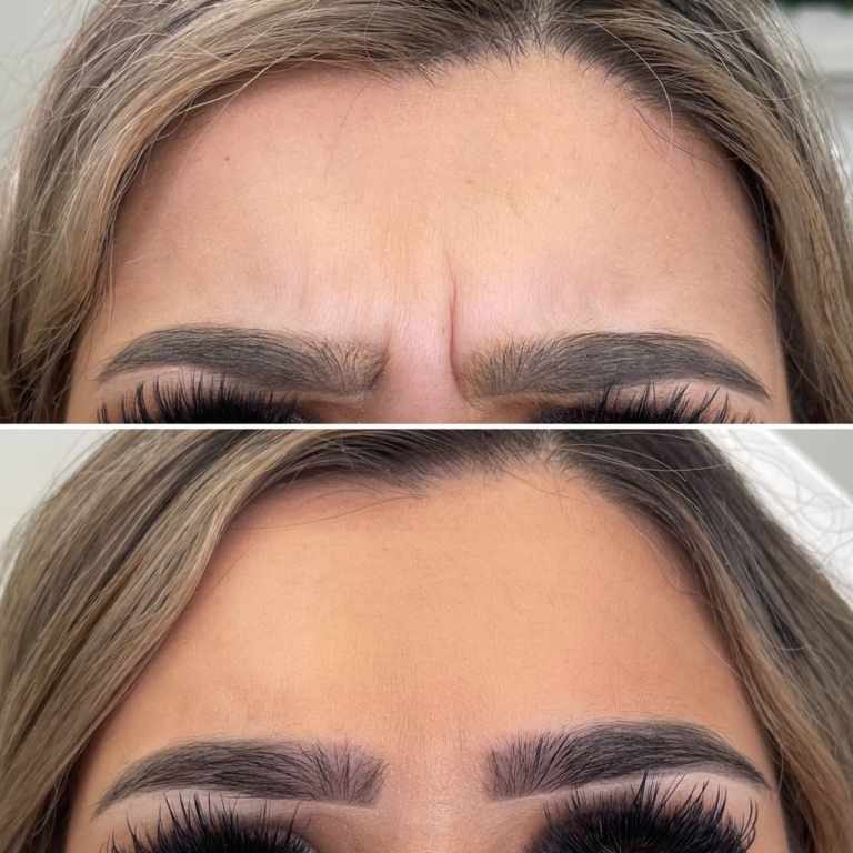 TOX (Botox, Dysport, Xeomin, Daxxify) - The Flawless Lab - Scottsdale ...