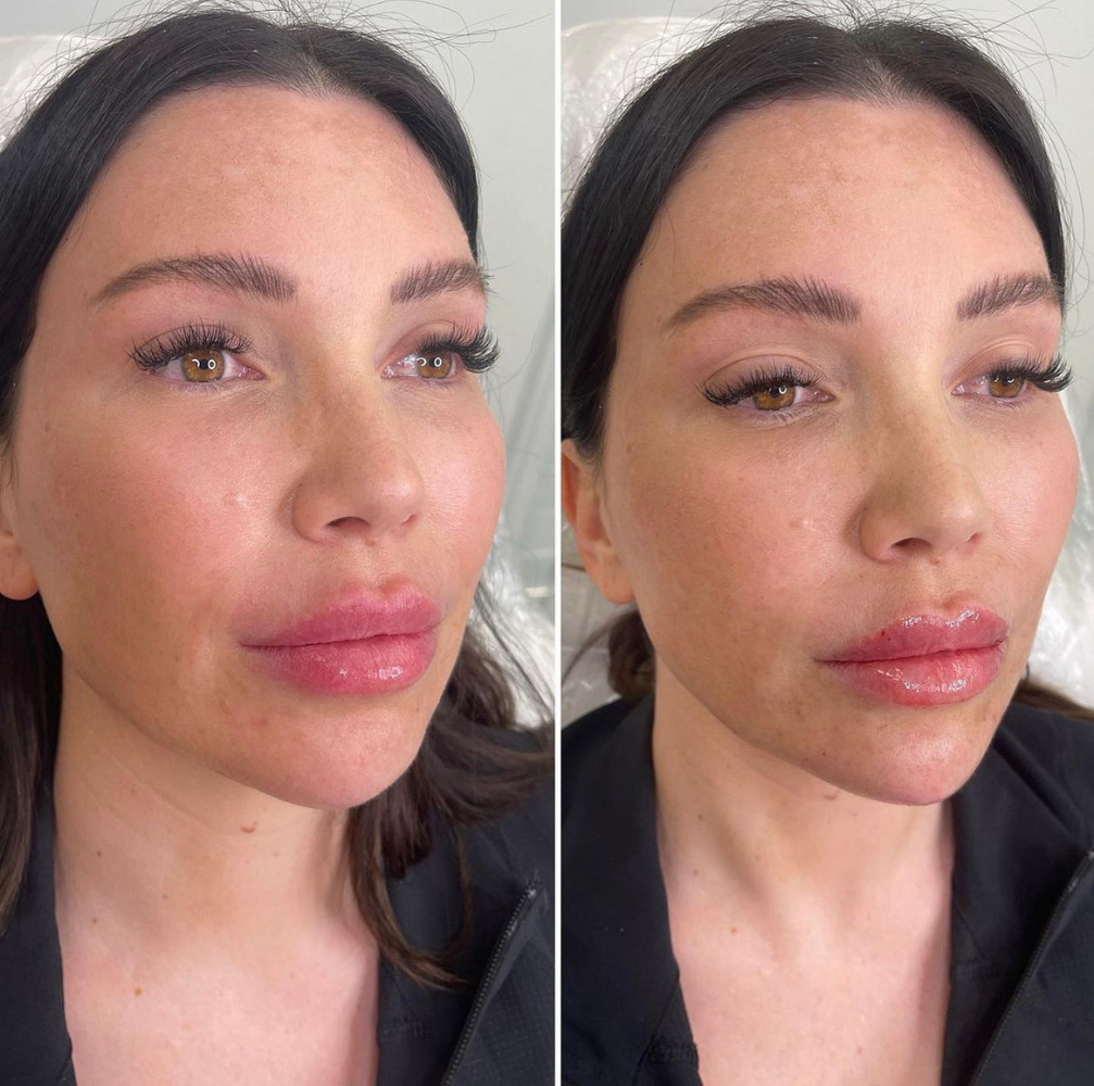 Chin Filler - The Flawless Lab - Scottsdale, Arizona