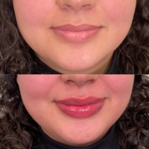 Lip Filler - Full Syringe - The Flawless Lab - Scottsdale, Arizona