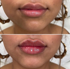 Lip Filler - Full Syringe - The Flawless Lab - Scottsdale, Arizona