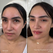 Filler Packages - The Flawless Lab - Scottsdale, Arizona