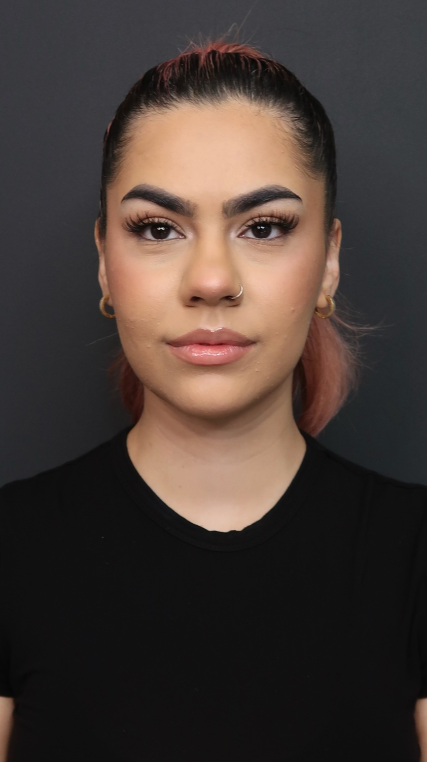 Filler Model - The Flawless Lab - Scottsdale, Arizona